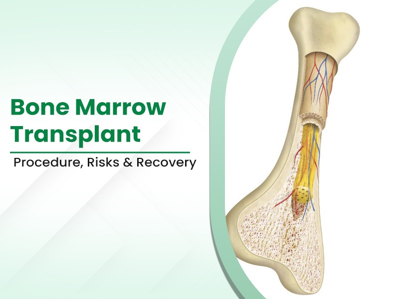 Bone Marrow Transplant: Procedure, Risks & Recovery